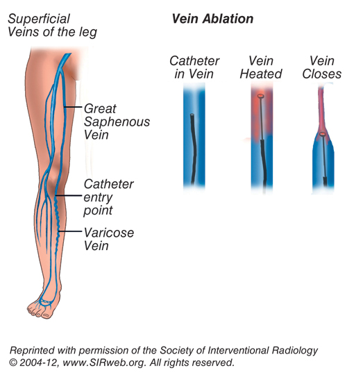 Endovenous Laser Vein Ablation AVA NJ